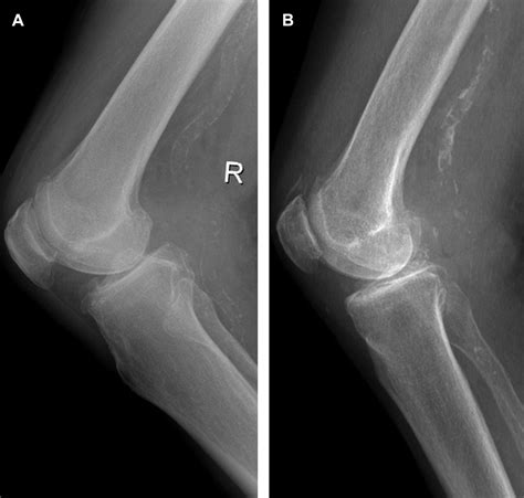 What Are Vascular Calcifications In The Pelvis At Timothy Horton Blog