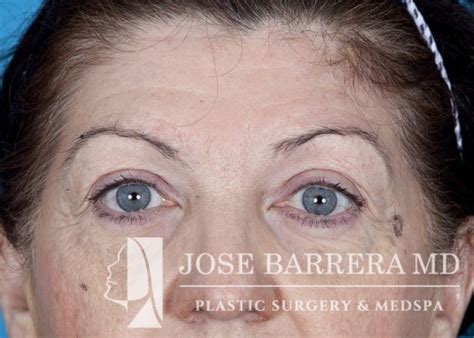 Blepharoplasty Case 10972 Dr Jose Barrera San Antonio Facial Plastic Surgeon And Ent