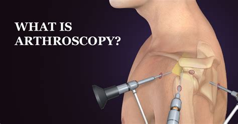 What Is Arthroscopy Welcome To Sys Medtech International Pvt Ltd