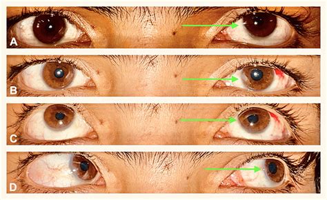 Novel Inferior Oblique Muscle Y Splitting Procedure To Minimize The An Opth
