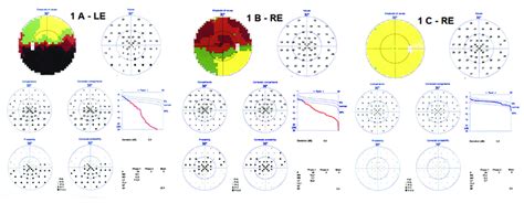 Static Perimetry Showed Inferior Altitudinal Defect In The Left Eye A