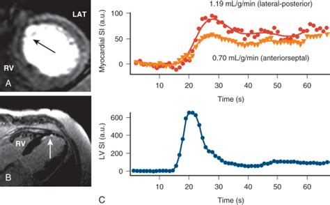 Myocardial Perfusion Imaging Theory Radiology Key