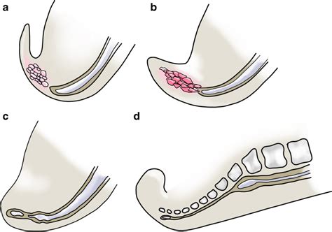 Illustrations Of Secondary Neurulation Which Begins During Weeks 5 6 Download Scientific