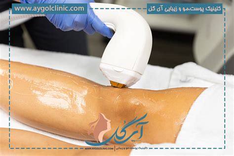 برای لیزر دستگاه شاتی بهتره یا رولی؟ آی گل