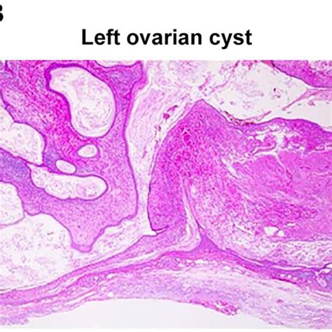 Pathological Findings Right Ovarian Cyst A Left Ovarian Cyst B