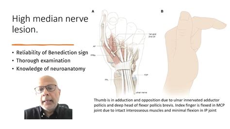 Median Nerve Palsy