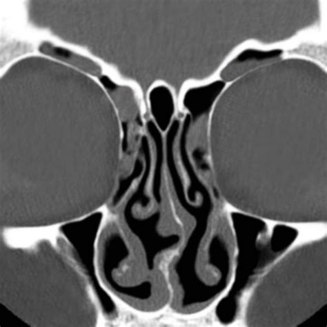 A Waters Radiograph Showing Maxillary Sinus Mucosal Thickening