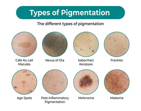 How To Get Rid Of Pigmentation Aesthetic Clinic Malaysia