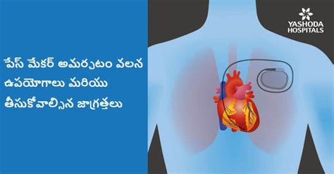 Marcapasso Cirurgia Procedimento Riscos Complicações E Benefícios