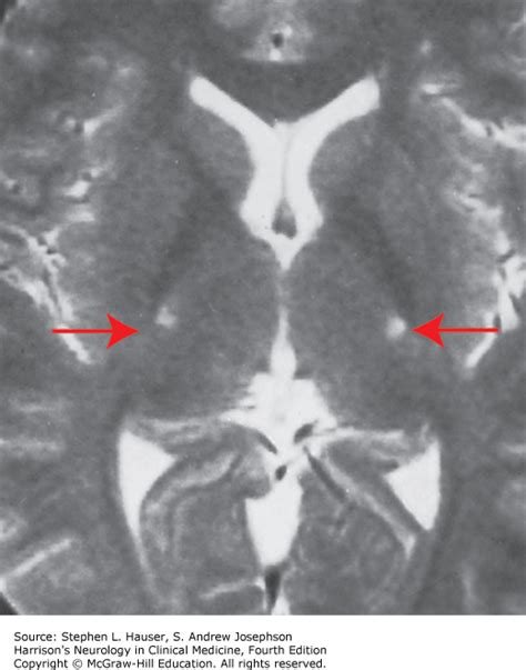 Amyotrophic Lateral Sclerosis And Other Motor Neuron Diseases Neupsy Key