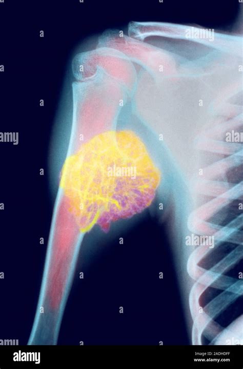 Bone Tumour Coloured X Ray Of Osteochondroma A Benign Non Cancerous