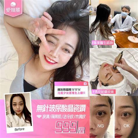 愛爾麗診所 高雄 🐼睡飽飽卻還是飽受淚溝陰影黑眼圈的困擾嗎 17直播主🌺游游cccccccandice