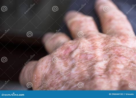 Eczema With Redness Swellings Bumps And Flakes On The Hand And