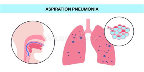 Aspiration Pneumonia Poster Stock Illustration Illustration Of Inhale Vector 374012123