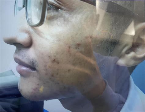 4 Months Post Accutane Raccutane