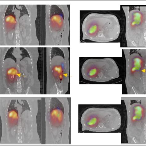 Patient 6 Left And 8 Right Co‐registered Computed Tomography Ct Download Scientific