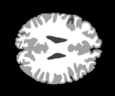 Segmentation Of A Single MRI Scan Slice From The BrainWeb Dataset A