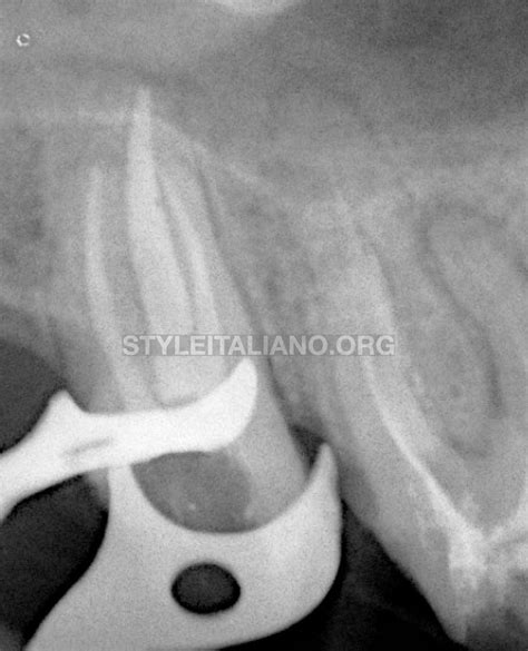 Ledge Detection And Bypass With Explora After Broken File Removal Style Italiano Endodontics
