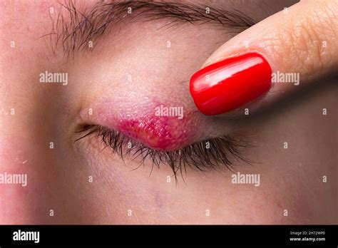 Hautpickel Auf Dem Augenlid Fotos Und Bildmaterial In Hoher Auflösung