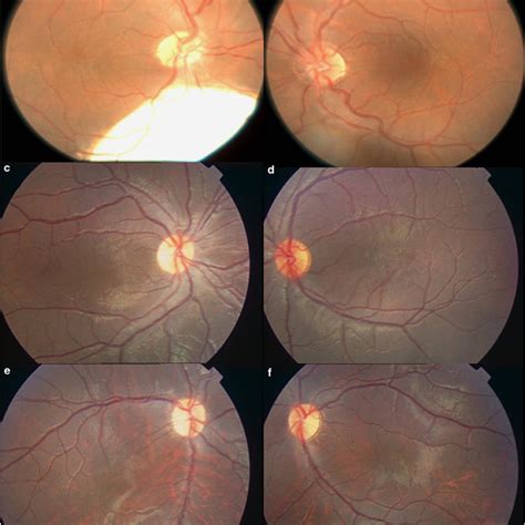 Fundus Photographs Of The Three Cases A And B Are The Fundus Download Scientific Diagram