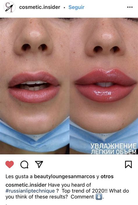 Pin By Cynthia Jasso On Lip Augmentation Lips Inspiration Facial