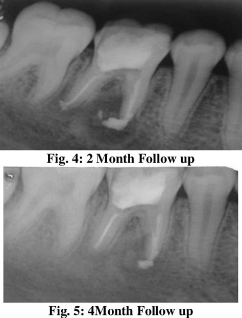 Periapical Abscess Radiograph Periapical Abscess Radiograph