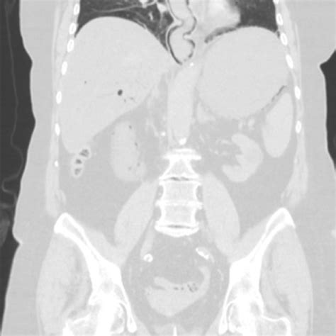 Ct Scan Sagittal Multiplanar Reformatted Maximum Intensity Projection