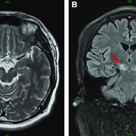Brain Magnetic Resonance Imaging Of The Right Midbrain In T2 Weighted