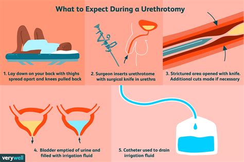 Optical Internal Urethrotomy In Iran Medpersia Medical Tourism