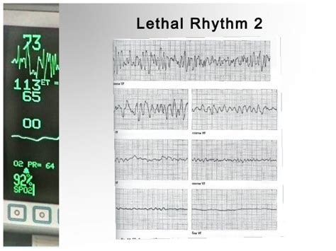 Lethal Heart Rhythms