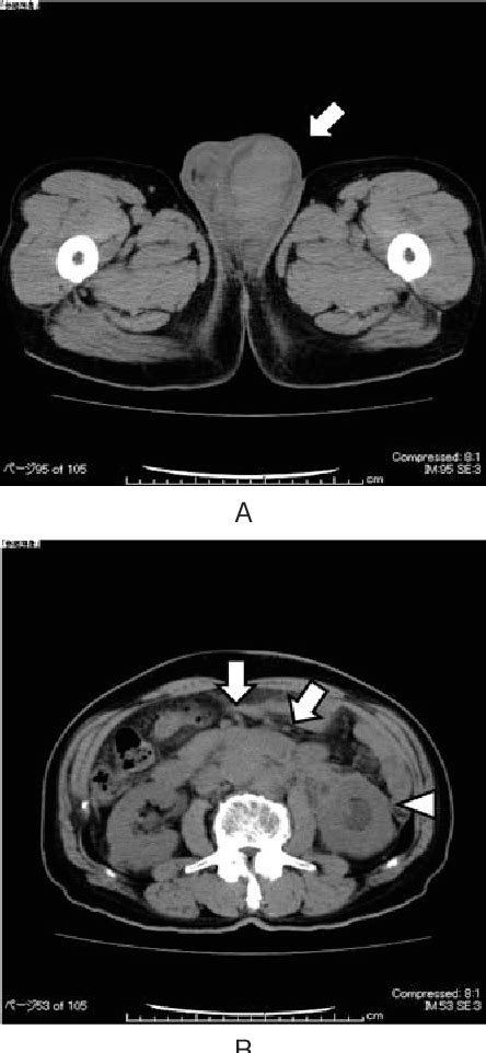 Figure 1 From Spontaneous Tumor Lysis Syndrome In A Patient With