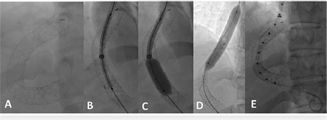 Single Balloon Expandable Covered Stent Technique For Tips Reduction