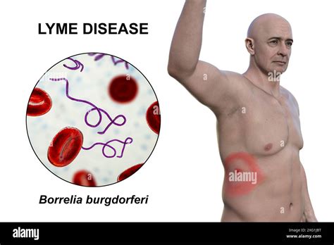 Illustration Showing Erythema Migrans A Characteristic Rash Seen In