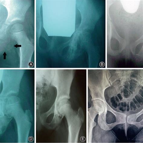 Showing The Preoperative And Postoperative Radiographs For Case‐5 In