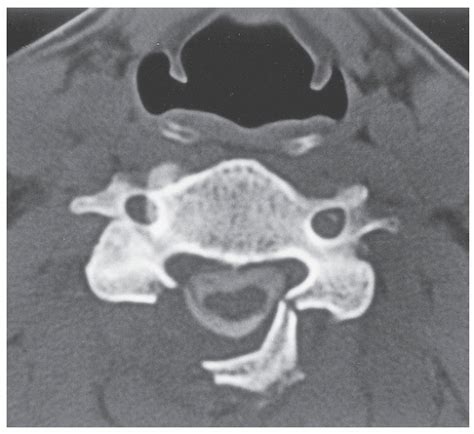 Unilateral Facet Dislocation Surgery Versus Nonoperative Treatment Neupsy Key