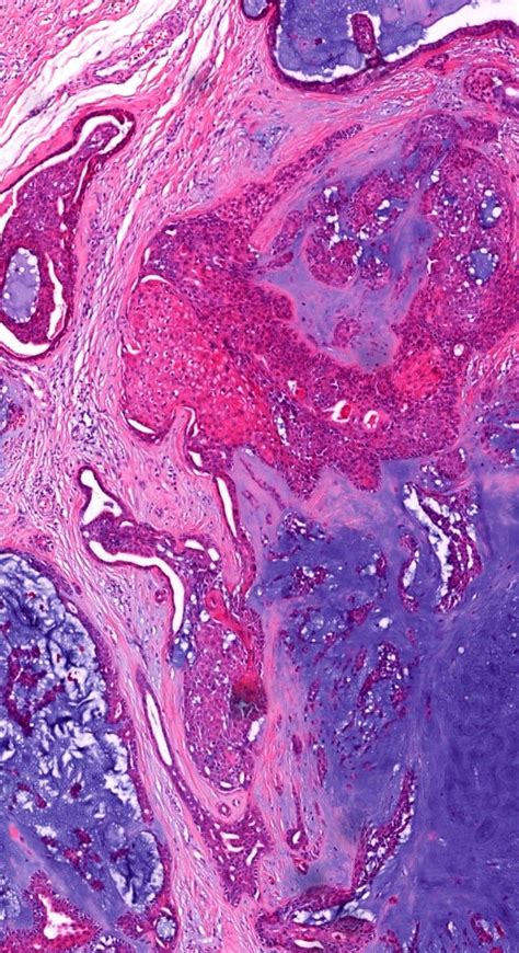 Pathology Of Chondroid Syringoma Histology Slides Microscopic Images