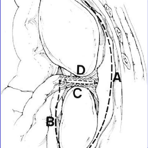 Positioning Of The Patient For A Right Sided Laparoscopic Radical