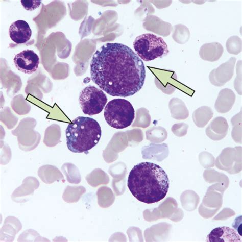 Myelodysplastic Syndrome Bone Marrow