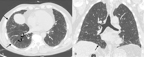 Possible Uip Pattern In A 77 Year Old Man The Possible Uip Pattern