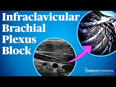Ultrasoundguided Infraclavicular Brachial Plexus Block