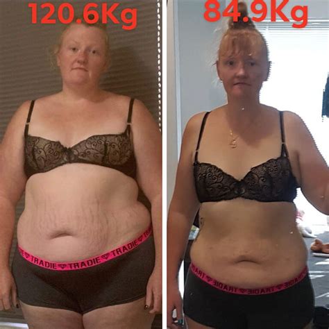 Bariatric Surgery Results From Real People In Perth