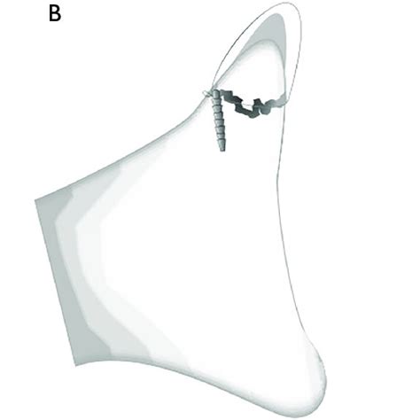 Diagram Depicting Arthroscopic Suture Anchor Techniques A Described Download Scientific