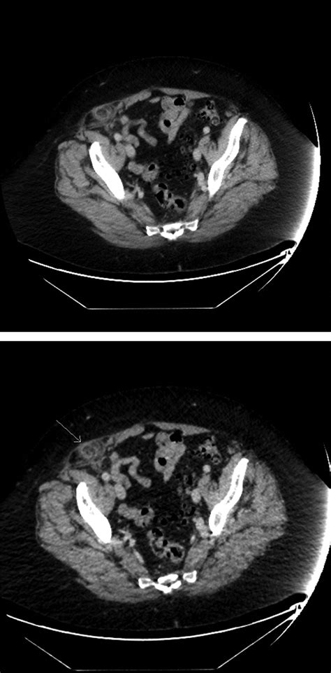 Transverse Computed Tomography Demonstrates The Appendix Arrow Download Scientific Diagram