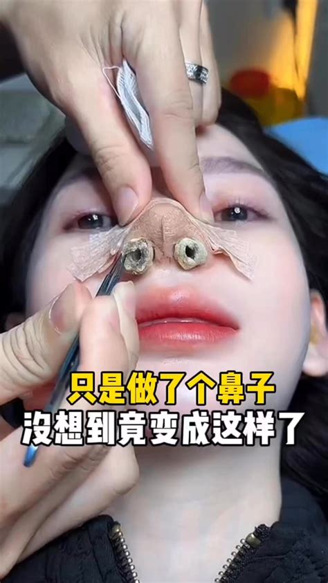 I Deserve All This Beauty整形变美眼鼻综合磨骨 王海阳