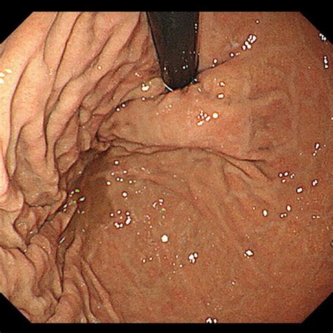 Endoscopic Intraluminal View Of The Partial Fundoplication Wrap From A
