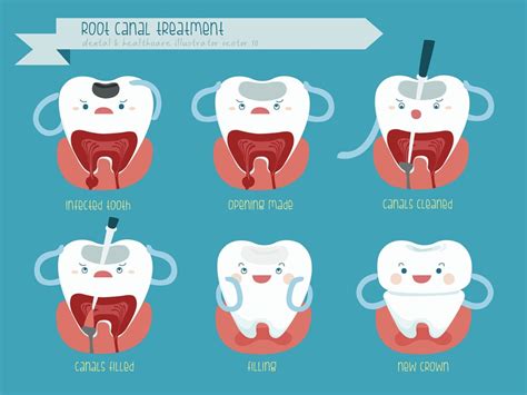 Can You Get A Filling Instead Of A Root Canal