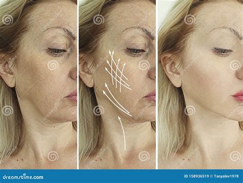 Woman Wrinkles Arrow Sagging Skin Cosmetology Correction After Lifting