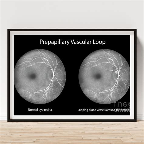 Prepapillary Vascular Loop On The Retina 5 Poster By Kateryna Kon