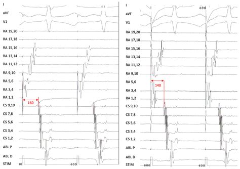 Electrogram Interpretation 3 Ep Essentials