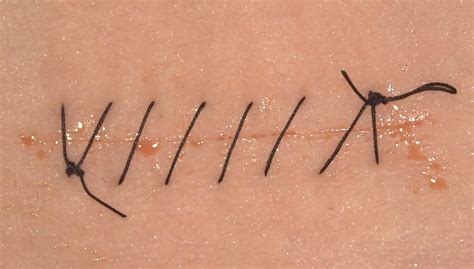 Simple Running Suture Technique How To Master It Upsurgeon